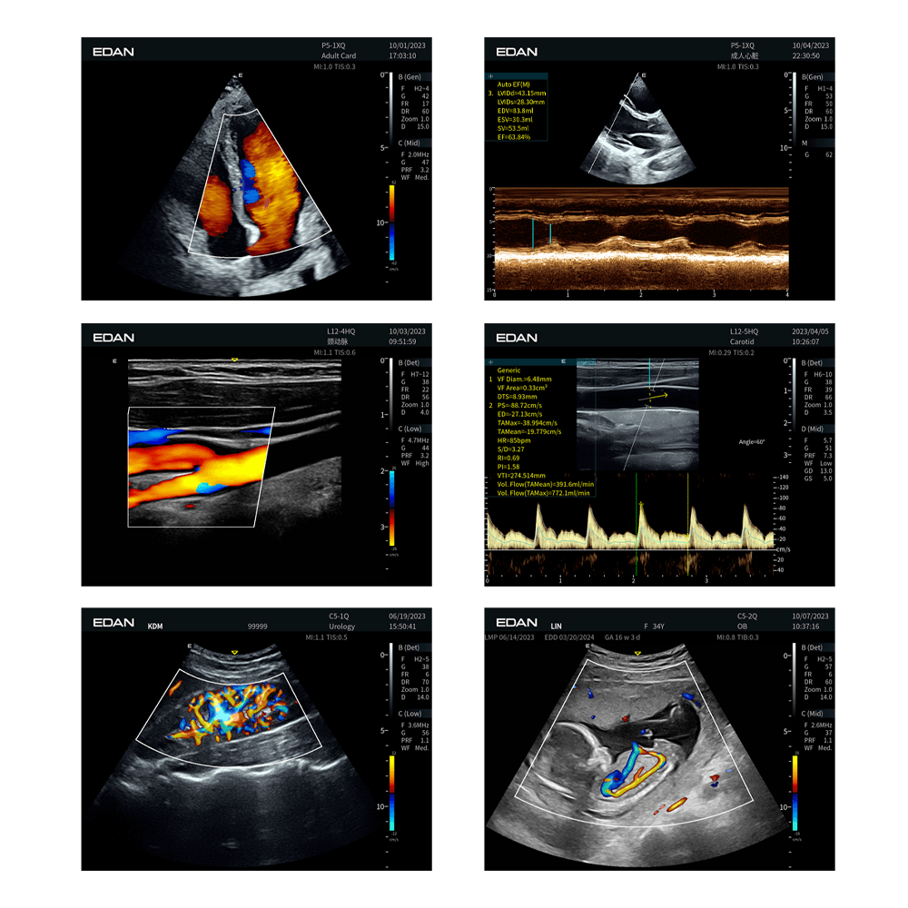 Ultrassom Portátil Acclarix AX9 - Edan